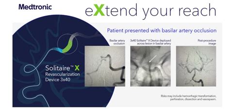 Medtronic Neurovascular On Linkedin Solitaire X Ais Revascularization Products