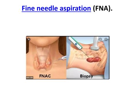 lymph node biopsy pptx