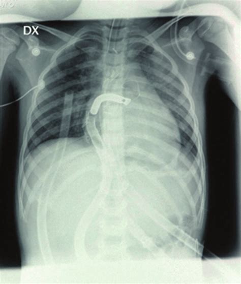 Chest X Ray Demonstrating Aortic And Right Atrial Lvad Cannulas