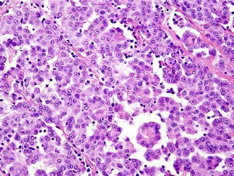 Malignant Pleural Mesothelioma Epithelioid Type Download Scientific
