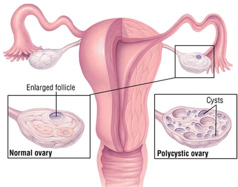 Your Ultimate Guide To Pcos What Is It And How To Deal With It Ezra Clinic