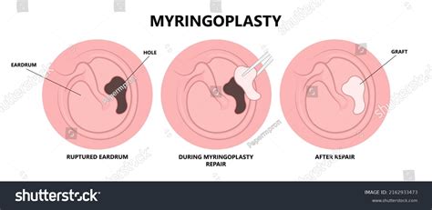 Perforated Eardrum Otitis Media At Joshua Ingram Blog