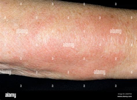 Ibuprofen Overdose Skin Rash At Georgia Kirsova Blog