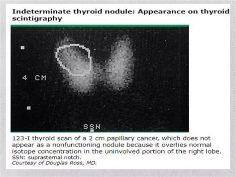 Approach To Thyroid Nodule Pptx Thyroid Disorders Endocrine And