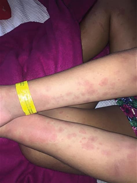 Exantema Maculopapular Violáceo 4° Dia Evolução Download