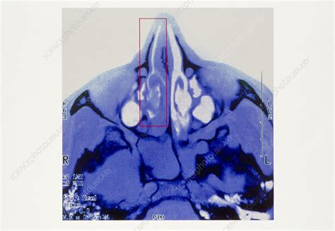 Sinusitis Ct Scan Stock Image M260 0196 Science Photo Library