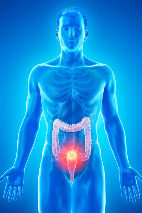 Gastro Intestinal Cancers Medlama