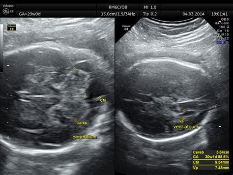 Choroid Plexus Cyst Looking Through A Transducer