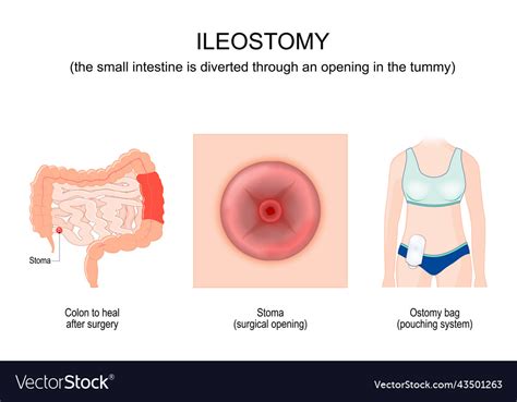 Ileostomy