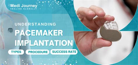 Understanding Pacemaker Implantation Types Procedure And Success Rate