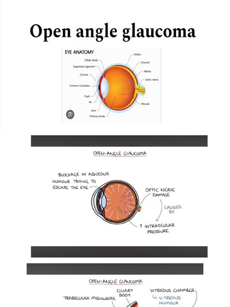 Open Angle Glaucoma 2 Pdf