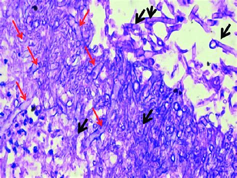 Photomicrograph Showing Numerous Broad Aseptate Red Arrow Mucor Like