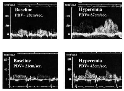 Spectral Doppler Flow At Rest And During Hyperemia In A Normotensive