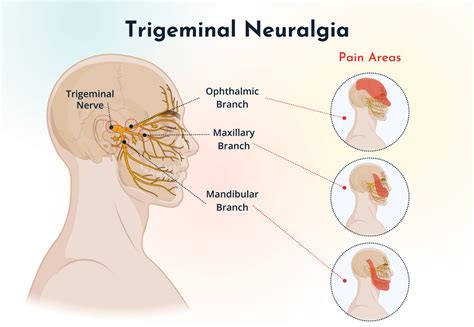 Trigeminal Neuralgia Coping Strategies And Support Resources