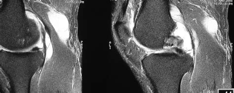 Popliteal Cyst Radiopaedia