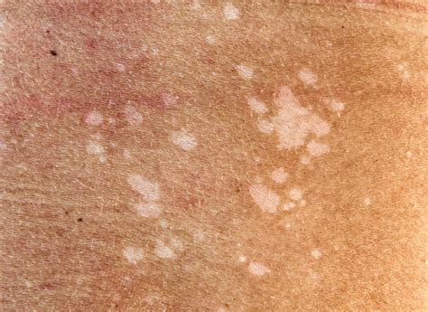 Pityriasis Rosea Vs Tinea Versicolor Good Captions