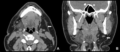 Multislice Computed Tomography Axial A And Coronal B Reformats Of
