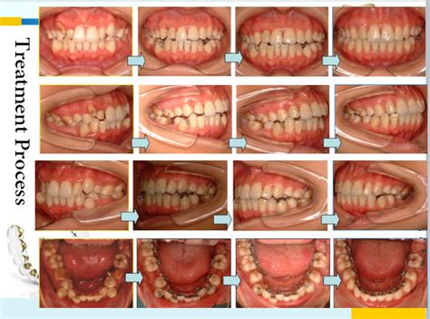 Step By Step Better And Better Lingual Braces Ebrace Teeth Braces