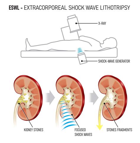Extracorporeal Shock Wave Lithotripsy Atlantic Urology Clinics