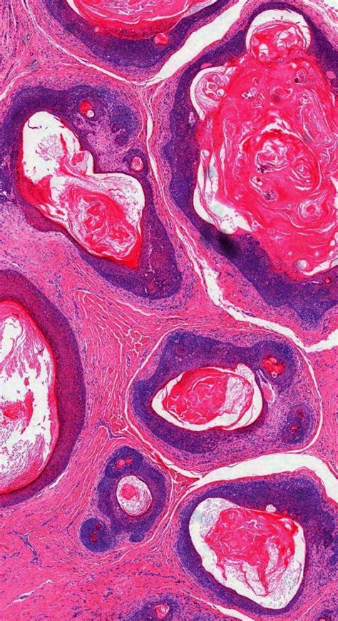 Pathology Of Trichoadenoma Pathology Microbiology Microscopic Images