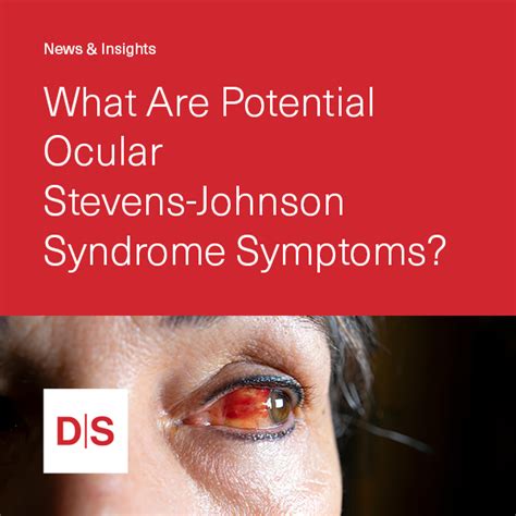 Ocular Stevens Johnson Syndrome Symptoms To Know Dunn Sheehan Llp