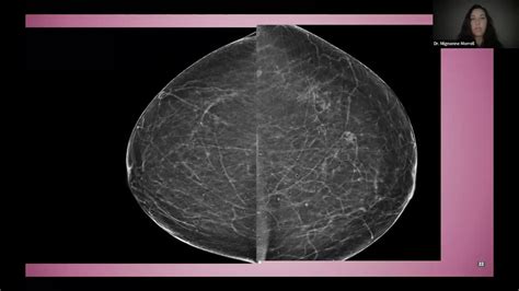 Understanding Mammograms Louisiana Cancer Research Center