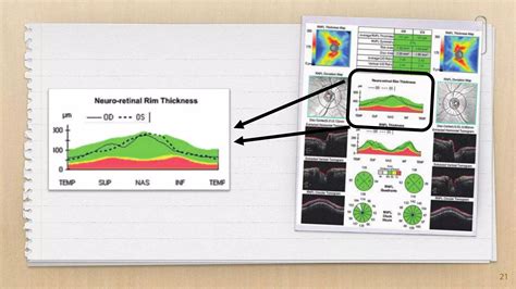 Interpretation Of Oct Glaucoma Pptx
