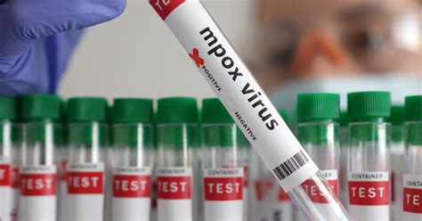 New Case Of Mpox Variant Clade Lb Detected In England Reuters