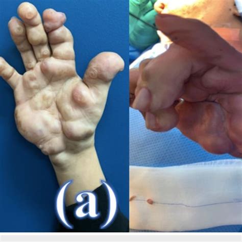 Preoperative Photo Showing Two Large Back Nodules Left Back Lesions Download Scientific