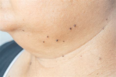 Skin Tags On Neck