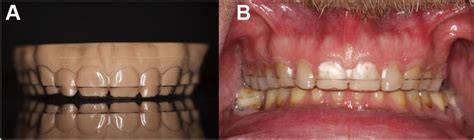 Photograph Showing The Crown Lengthening Template A On The Printed