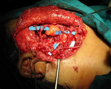 Intra Operative View Following Completion Of Dissection The Masseter