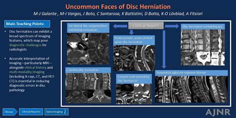 Uncommon Faces Of Disc Herniation Atypical Imaging Presentations And