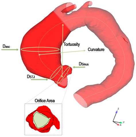 Ascending Thoracic Aortic Aneurysm