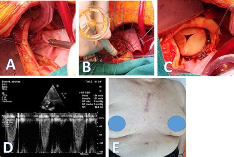 Yang Aortic Root Enlargement Through Ministernotomy In An Obese Patient