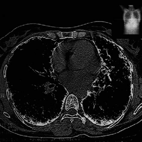 Hrct Thorax Showing Diffuse Bilateral Calcified Fine Nodular Pattern Download Scientific