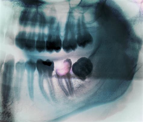 Tooth Decay X Ray Photograph By Zephyr Fine Art America