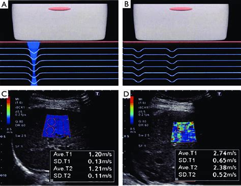 Liver Stiffness By Share Wave Elastography A It Shows Tissue Download Scientific Diagram