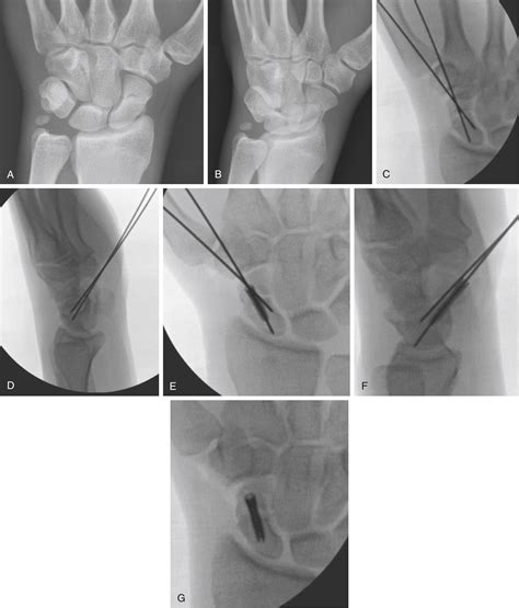 Technique Spotlight Scaphoid Fractures—volar Vs Dorsal Open Vs Percutaneous Bone Graft