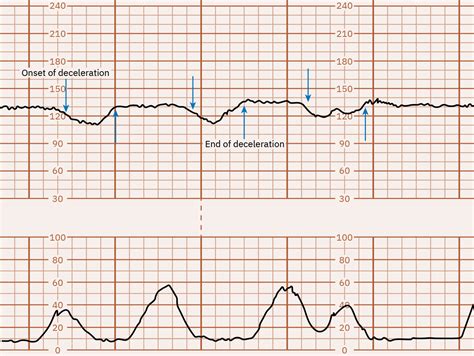 16 2 Basic Terms Of Fetal Heart Rate And Contraction Patterns Medicine Libretexts