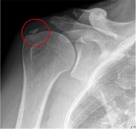 Boston Sports Rotator Cuff Calcification Shoulder Calcification …