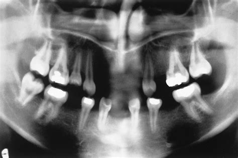 Ectodermal Dysplasia Ace Achievers