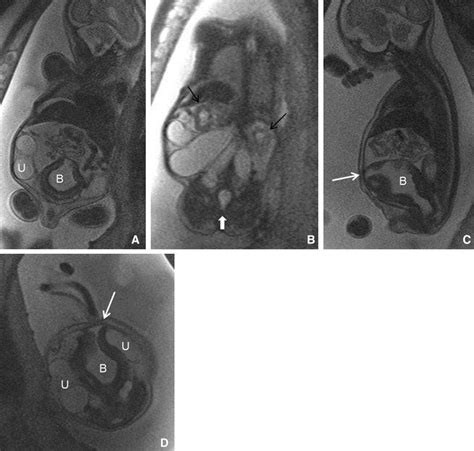 Lower Urinary Tract Obstruction Posterior Urethral Valves And Patent Download Scientific