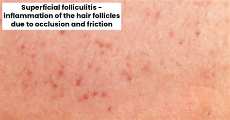 Bottoms Up Tackling Butt Acne Dermatology Circle Nyc