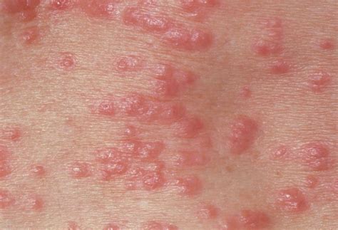 How To Identify 4 Common Skin Rashes Artofit