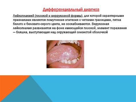 Кандидоз полости рта у детей Online Presentation