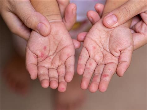 Hand Foot And Mouth Disease The Inevitable Scourge Of Daycare The