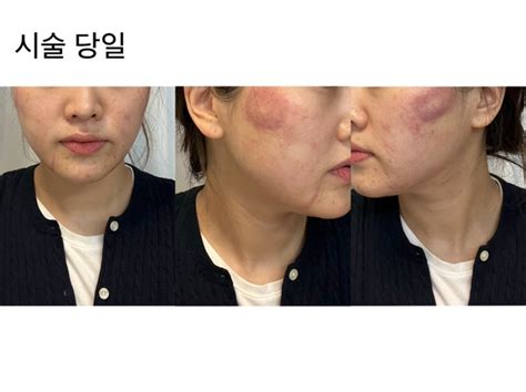 인모드 리프팅 후기 압구정 피부과 인모드 키닥터 인모드 잘하는 곳 인모드 1회차 통증 시술 당일 멍 후기 네이버 블로그