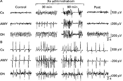 Typical Recordings Of Changes In The Electroencephalogram EEG During Download Scientific