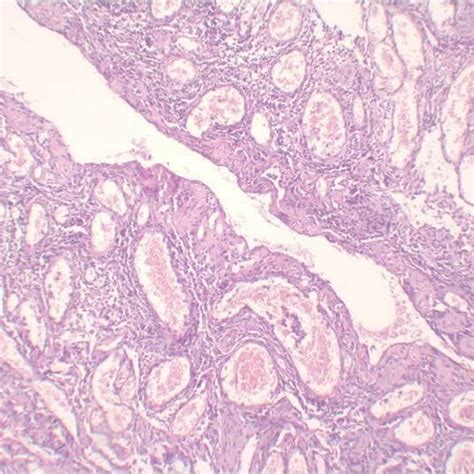 Polypoidal Growth Showing Blood Filled Spaces Along With Stratified